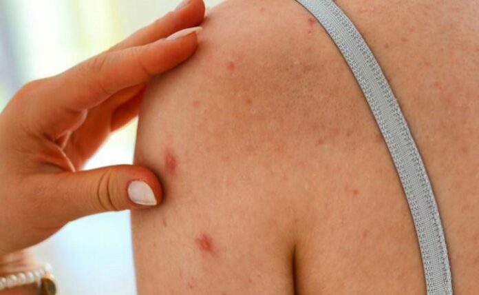 Fungal Acne: Beda dari Beruntusan, Ini Cara Menghilangkannya!