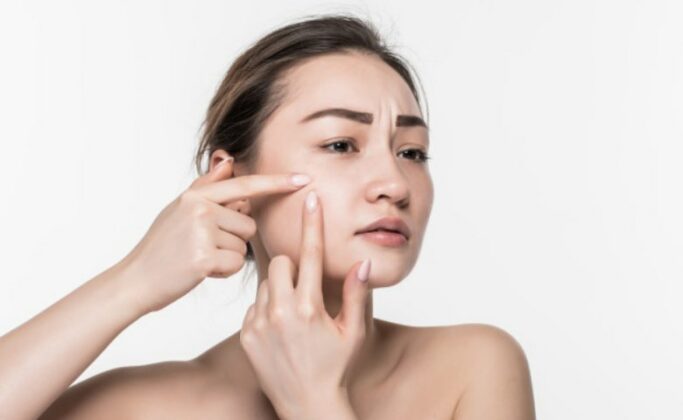 7 Cara Menghilangkan Milia di Wajah yang Aman dan Efektif