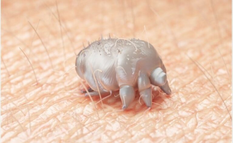 Scabies: Ciri-ciri, Penyebab & Cara Mengobati