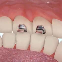 Jual Dental bite turbo ortho peninggian gigit gigitan anterior bite ...