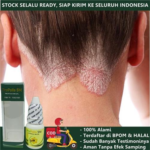 Jual Obat Penghilang Ketombe Parah - Berkerak - Bersisik Gatal Akibat Jamur - Kab. Bekasi - Toko ...