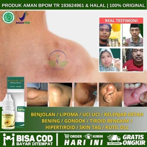 Jual Obat Benjolan Di Pantat , Benjolan Di Bokong , Fistula Ani ...