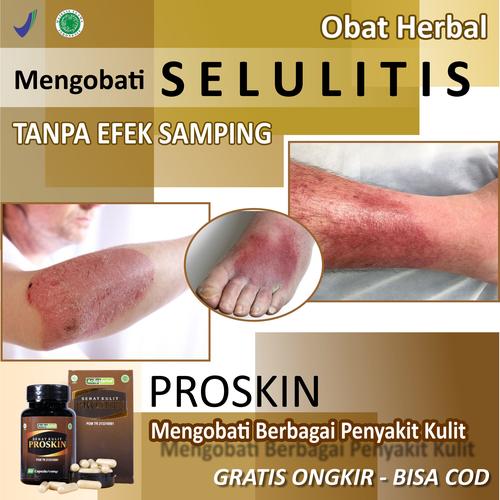Jual Obat Selulitis Kemerahan Infeksi Kulit Merah Pada Anak Dengan ...