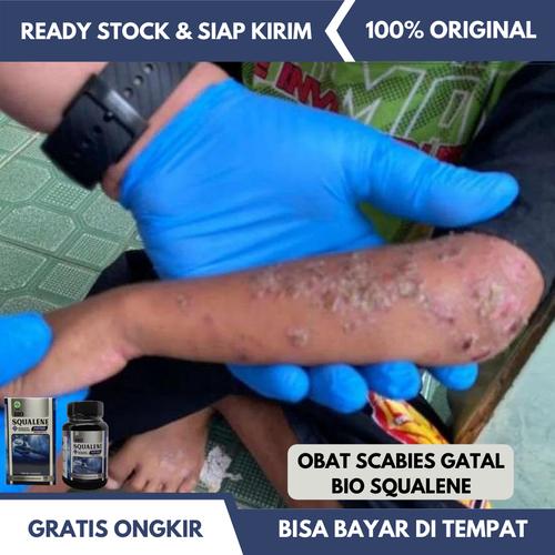 Jual Obat Scabies Manusia, Obat Gatal Scabies, Obat Kutu Scabies, Kudis ...