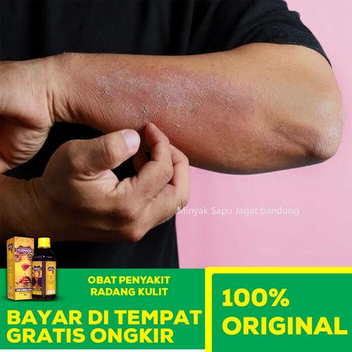 Jual Obat Radang Kulit, Ruam Kulit, Gatal, Kemerahan, Kulit Lecet ...