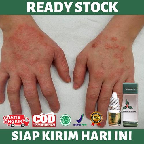 Jual Obat Dermatitis Seboroik, Dermatitis Atopik, Budug, Scabies, Gatal ...