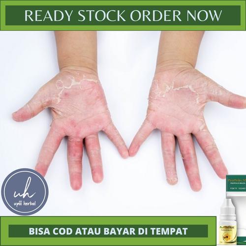 Jual OBAT OLES ALEGI DETEJEN, ECZEMA, DERMATITIS, EKSIM DISHIDROTIK,DLL ...