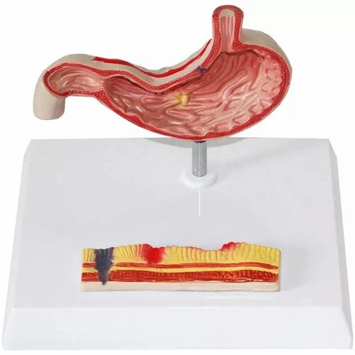 Jual Manekin Alat Peraga Model Anatomi Organ Ulkus Lambung Perut ...