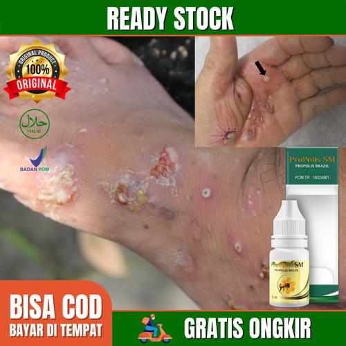 Jual Obat Kulit Borok Budukan Scabies Manusia,Dermatitis,Biduran ...