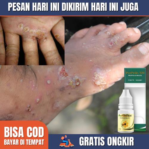 Promo Obat Kulit Budug Budukan Bernanah,Scabies Manusia,Kulit Herpes ...