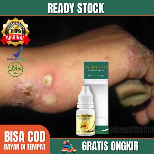 Jual Obat Kulit Borok Budug Scabies Manusia, Kulit Cenang Herpes ...