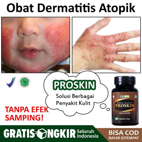Jual Penyembuh Dermatitis Atopik Alami Pengering Eksim Basah Obat ...