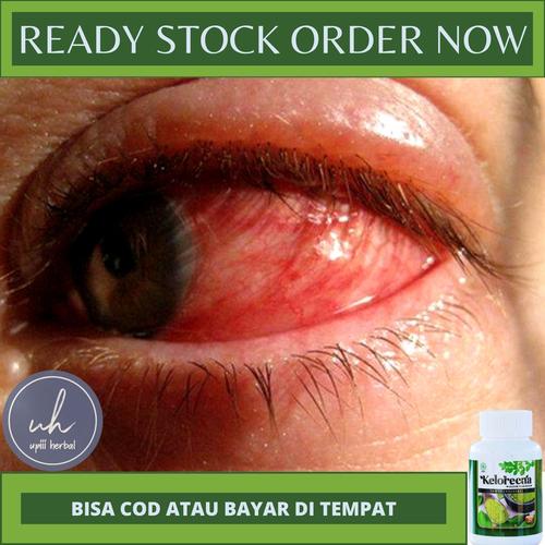 Jual OBAT PAPILLEDEMA,OBAT EDEMA MATA,OBAT PEMBENGKAKAN SARAF OPTIK ...