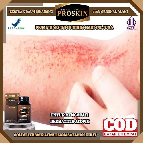 Jual Obat Dermatitis Atopik,Obat Gatal Kulit Dermatitis Atopik,Kulit ...