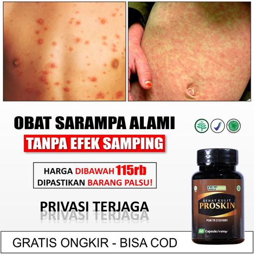 Jual Obat Kapsul Oles Gatal Sarampa Skabies Budug Santri Korengan ...