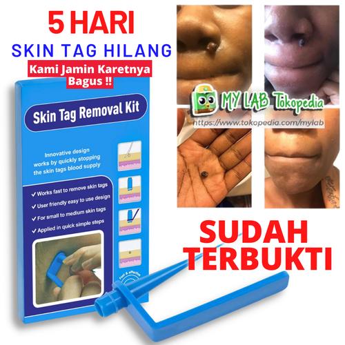 Promo Skin Tag Rubber Band Removal Tool Kit Obat Kutil Penghilang Tahi ...