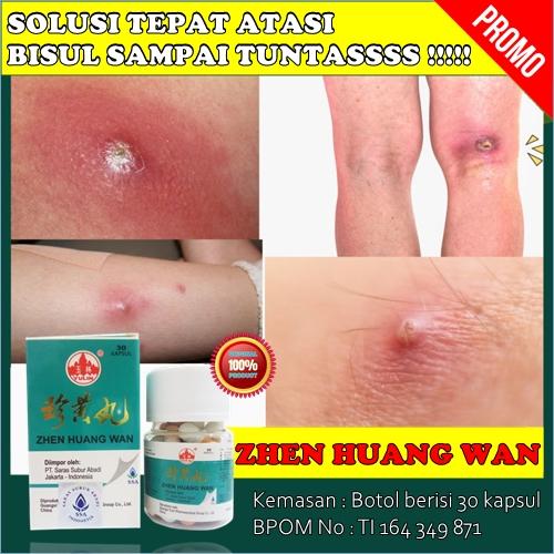 Jual obat bisul gatal pembersih darah kotor paling ampuh Zhen Huang Wan ...