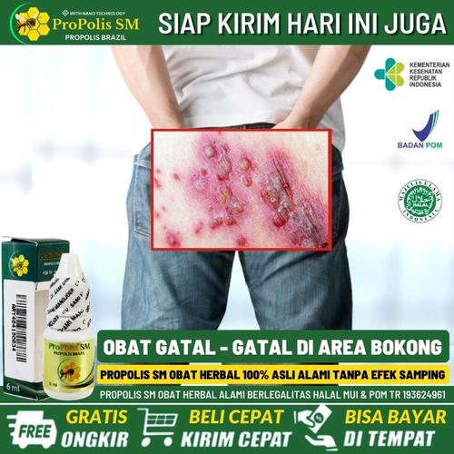 Jual Salep Tinea Cruris di Area Bokong, Salep Pantat Gatal, Bentol2x ...