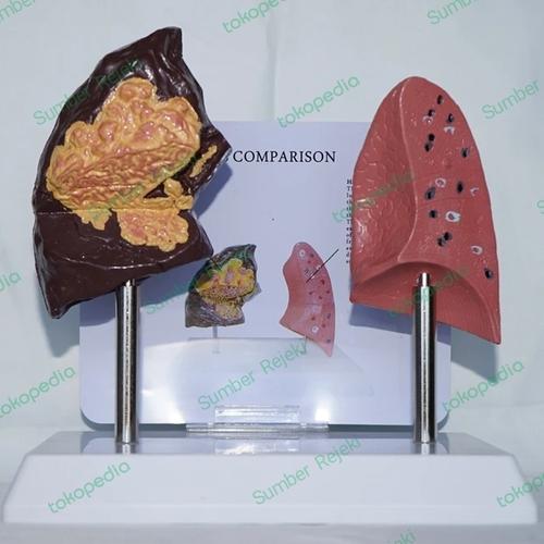 Jual Model Anatomi Paru Normal dan Paru Perokok - Kab. Kebumen - Umbul ...
