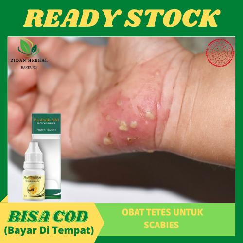 Jual Salep Scabies, Kudis, Gatal Bernanah, Infeksi Kulit Akibat Tungau ...