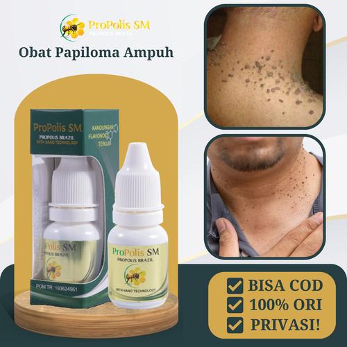 Promo Obat penghilang papiloma kutil skin tag daging jadi tumbuh di ...