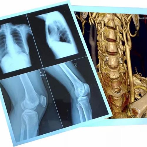 Jual medical film inkjet radiology blue base ukuran A3 215mikron CR DR ...