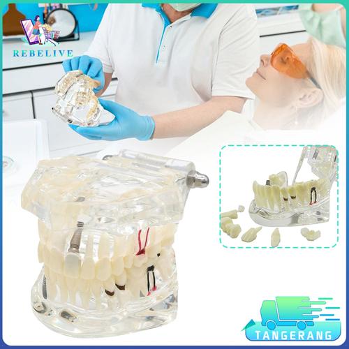 Jual Dental Study Model Gigi Transparant Phantom Gigi Removable - Kota ...
