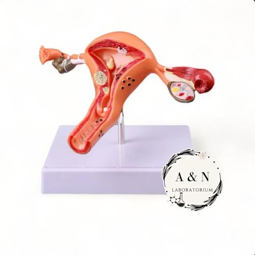 Jual Alat Peraga Model Rahim Ovarium Uterus / Normal - Pathological ...
