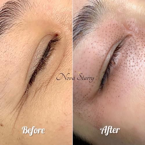 Jual Plasma Fibroblast Lifting by Nova Starry - Eyebag / eyelid - Jakarta Barat - Beauty Star ...