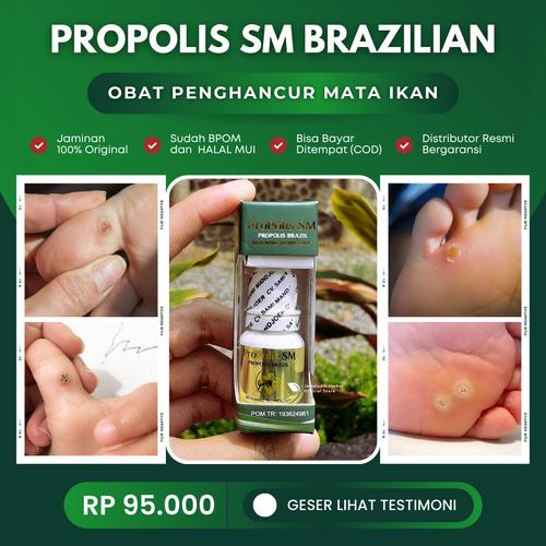 Jual Obat Mata Ikan di Telapak Kaki - Obat Oles Mata Ikan Propolis SM ...
