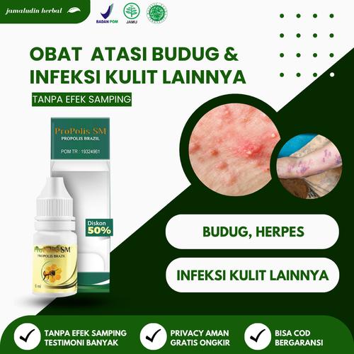Promo Obat Scabies Manusia - Obat Gudik Gudig - Obat Kudis Budug ...