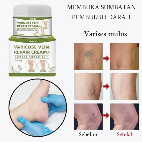 Jual EELHOE Varicose Veins Cream Obat Varises Kaki Ampuh Obat Varises ...