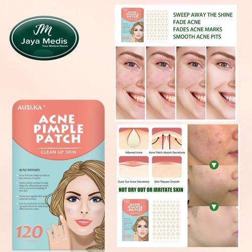 Jual ACNE PIMPLE PATCH - STIKER PENUTUP JERAWAT - 1 lembar - Jakarta ...
