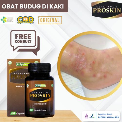 Jual Obat Budug Di Kaki, Obat Budug Bernanah Di Kaki, Gatal Bernanah ...
