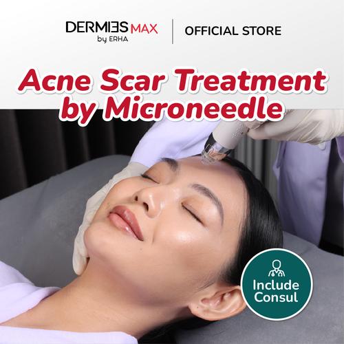 Promo Dermies Max Dermies Acne Scar Treatment by Microneedle - Jakarta ...