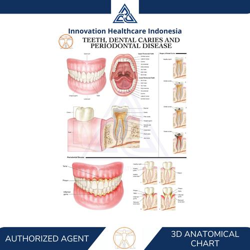 Promo 3D Anatomical Chart Teeth, Dental Caries and Periodontal Disease ...