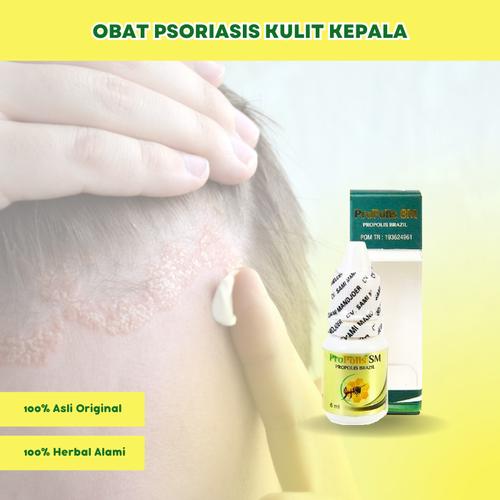 Jual Obat Psoriasis di Kulit Kepala Kering Bersisik Berketombe Propolis ...