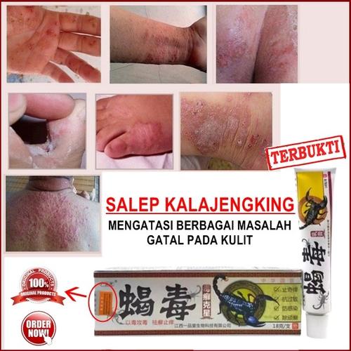 Jual Salep Kalajengking Scorpio Obat Gatal Alergi Eksim Kutu Air Ampuh ...
