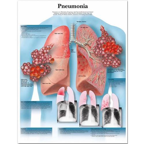 Jual POSTER ANATOMI PARU-PARU - PNEUMONIA - A3 + Artpaper - Jakarta ...