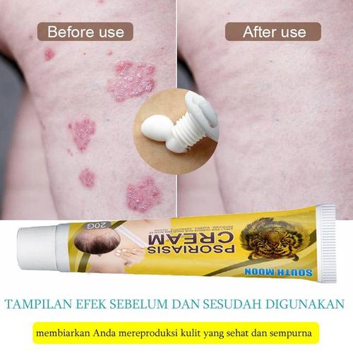 Jual Salep gatal Salep Eksim Salep kulit Krim psoriasis paling ampuh ...