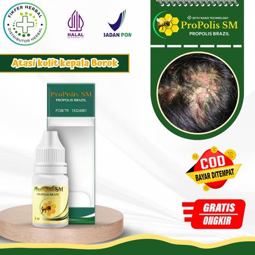 Jual Obat Kulit Kepala Borok, Obat Kepala Gatal - Gatal, Infeski Jamur Kulit Kepala, Obat Kepala ...