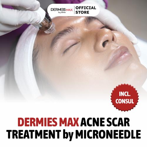 Promo Dermies Max Dermies Acne Scar Treatment by Microneedle Cicil 0% ...