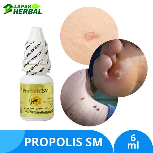 Jual Obat Kutil Leher Penghilang Skin Tag Papiloma Mata Ikan - Propolis ...