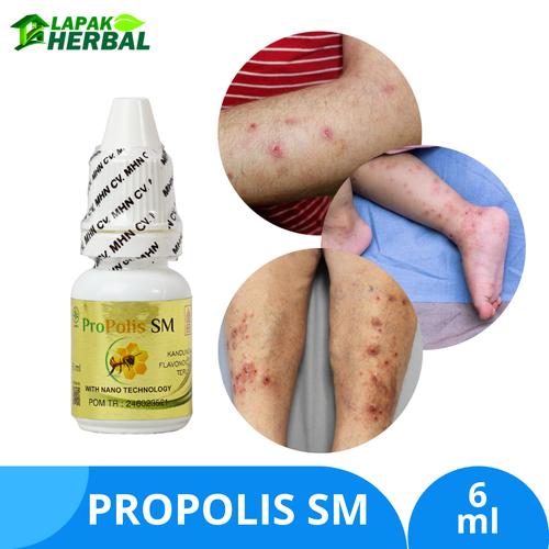 Promo Obat Koreng Bekas Luka Obat Darah Manis Prurigo - Propolis SM ...