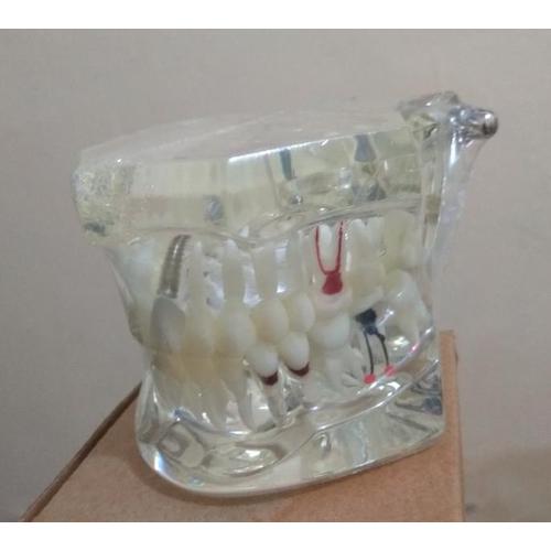 Jual PHANTOM GIGI IMPLANTS/ MODEL GIGI IMPLANTS RESTORATION - Jakarta ...