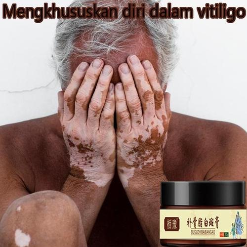 Jual Salep vitiligo membantu pertumbuhan melanin , Krim vitiligo ...