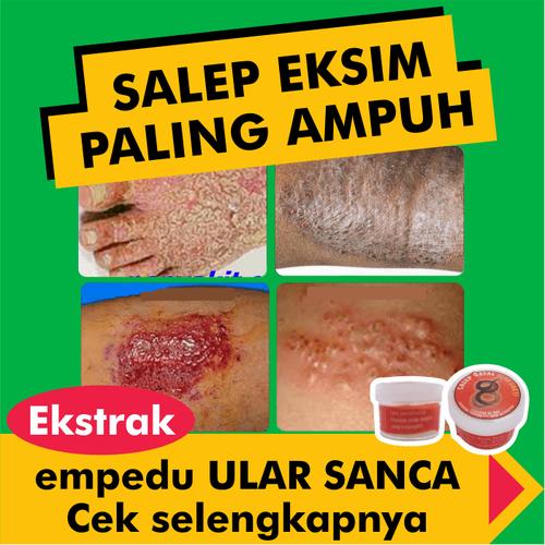 Promo Salep Obat Gatal Kulit Eksim Kering Paling Ampuh Gatel Exim Salap ...