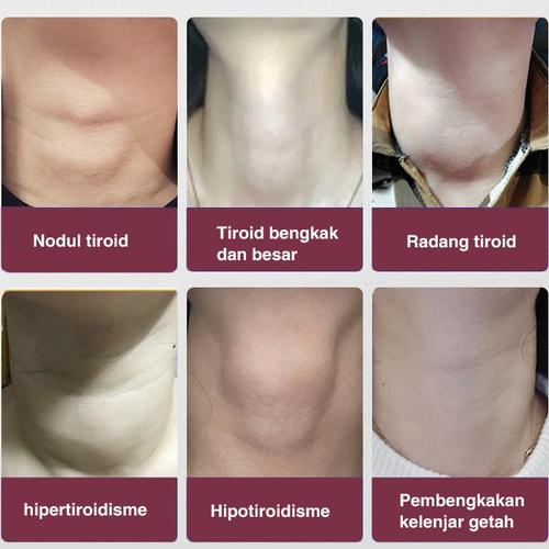 Jual [100% Berefektif]Obat Tiroid Obat Benjolan Di Ler Obat Gondok 30G ...