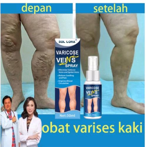 Jual SOLLORA spray Vericose menghilangkn nyeri varises dan varicose ...
