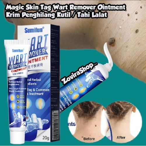 Jual 100%ORI- Salep Obat Penghilang Kutil-Skin Tag-Papiloma-Daging ...
